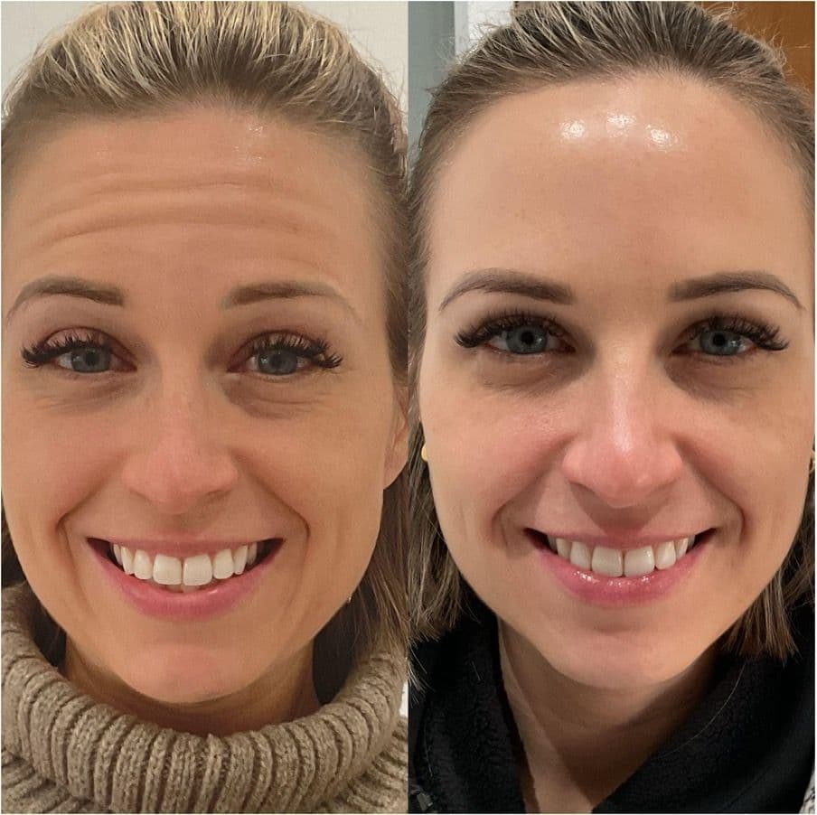 Understanding Botox: Effects, Maintenance Tips, and Results Timeline